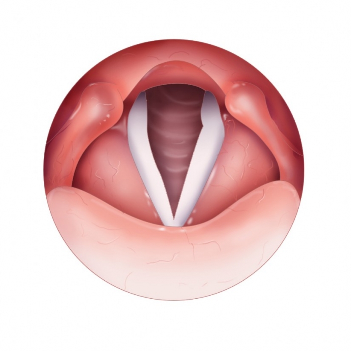 Vocal Fold Implants • Cytophil, Inc.