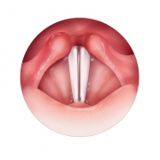 Vocal Fold Implants • Cytophil, Inc.