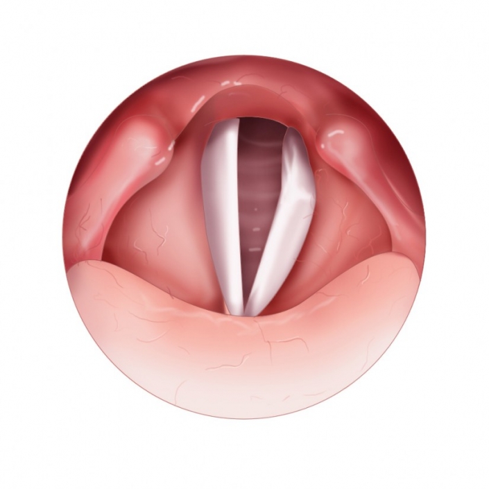 Vocal Fold Implants • Cytophil, Inc.